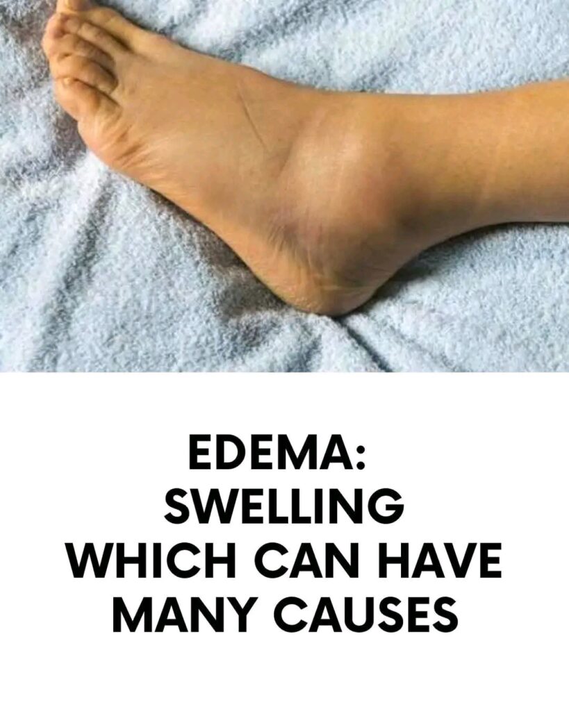 It’s a sign that something’s wrong. What you need to know about edema