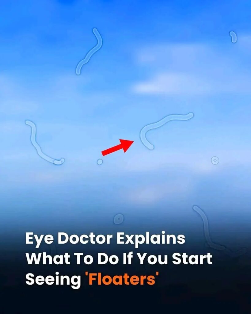 What Are Eye Floaters? Here’s What To Do If You Start Seeing Them