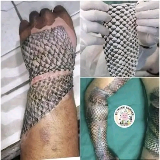 Doctors Are Using Fish Skin To Heal Burns — Results Are Changing Modern ...